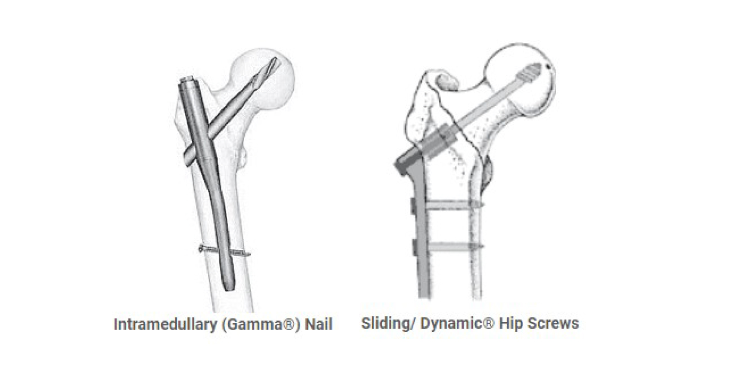 Hip Fracture Care Program - New Smyrna Orthopedics